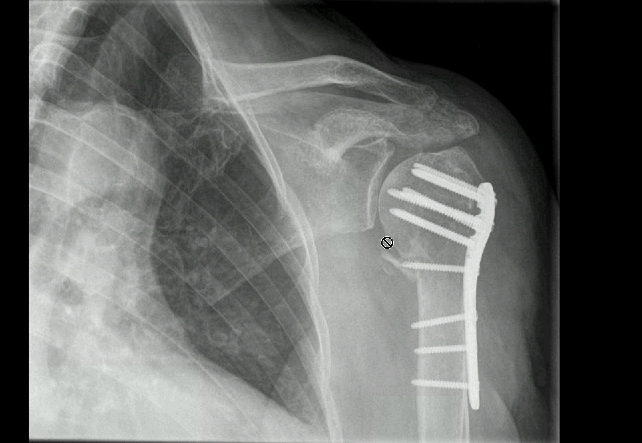 Schulter- , Schlüsselbein- und Ellenbogenverletzungen – Dietrich ...